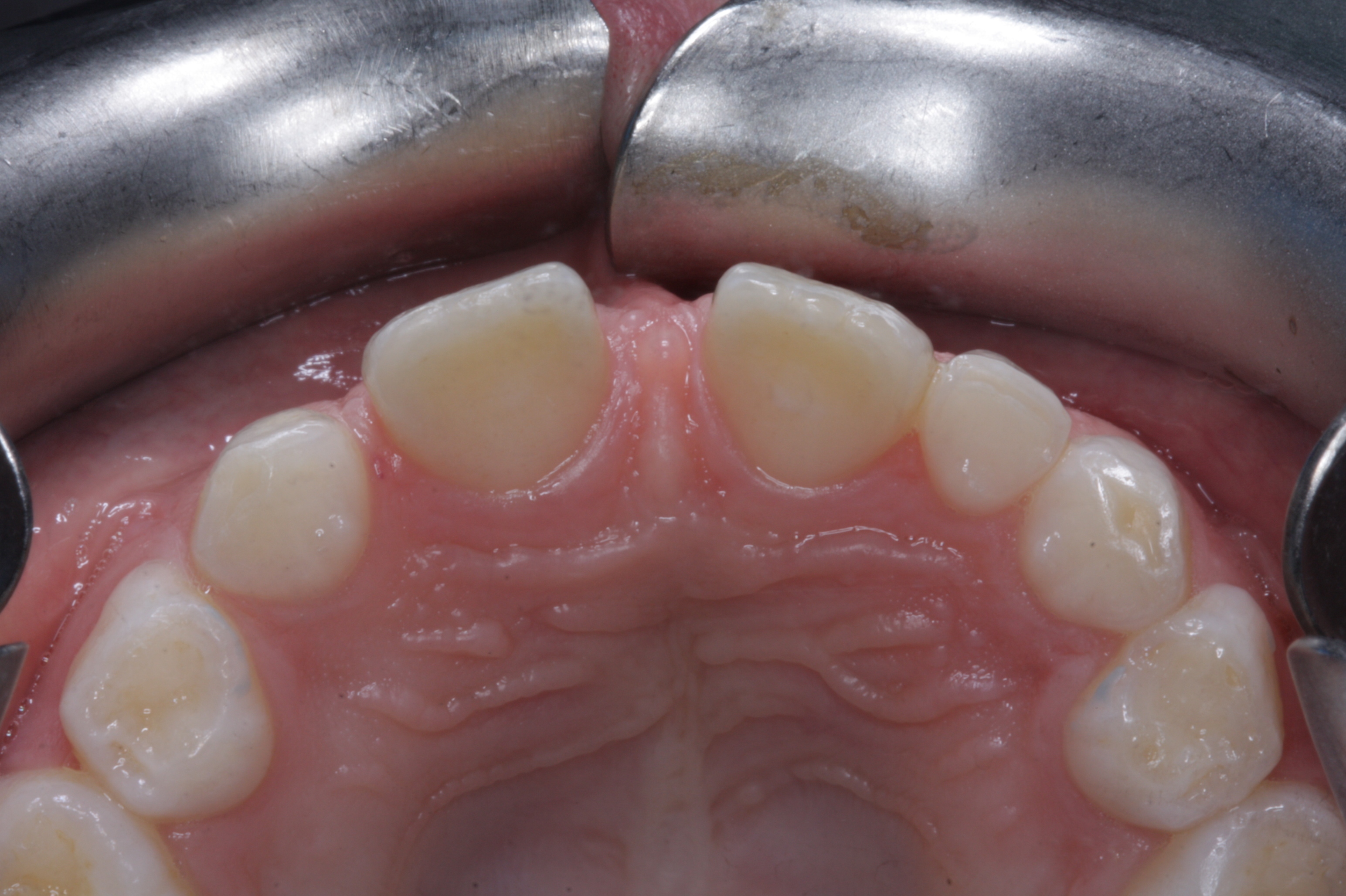 Swords Orthodontics Blog What Is A Frenectomy Does My Child Need One 