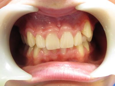 Swords Orthodontics's Smile Gallery | Original Problem: Abnormal Tooth ...