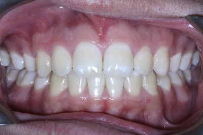 Swords Orthodontics's Smile Gallery | Original Problem: Abnormal Tooth ...