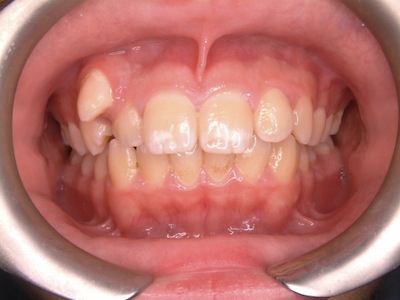 Swords Orthodontics's Smile Gallery | Original Problem: Abnormal Tooth ...