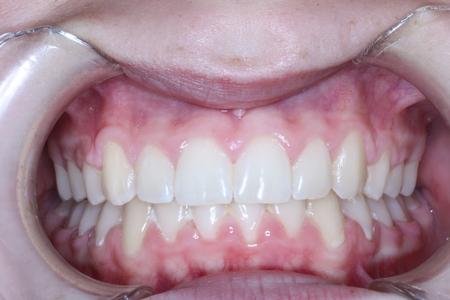 Swords Orthodontics's Smile Gallery | Original Problem: Abnormal Tooth ...